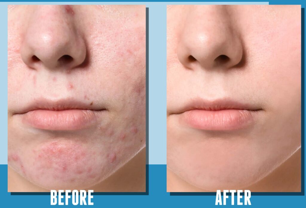 Acne - Dyson Dermatology
